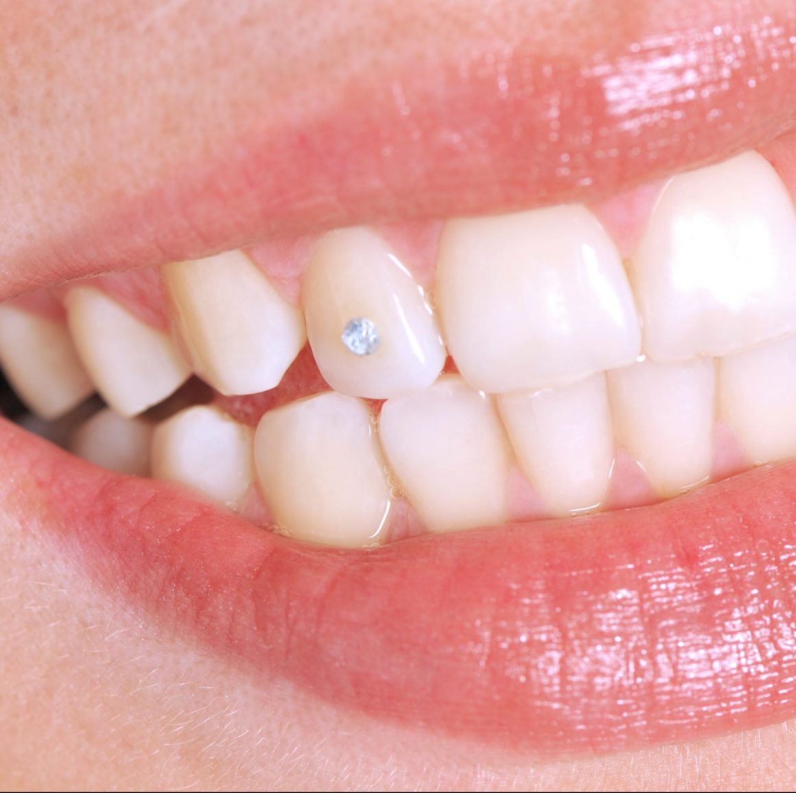 Zahnschmuck – Zahnarzt Mustafayev